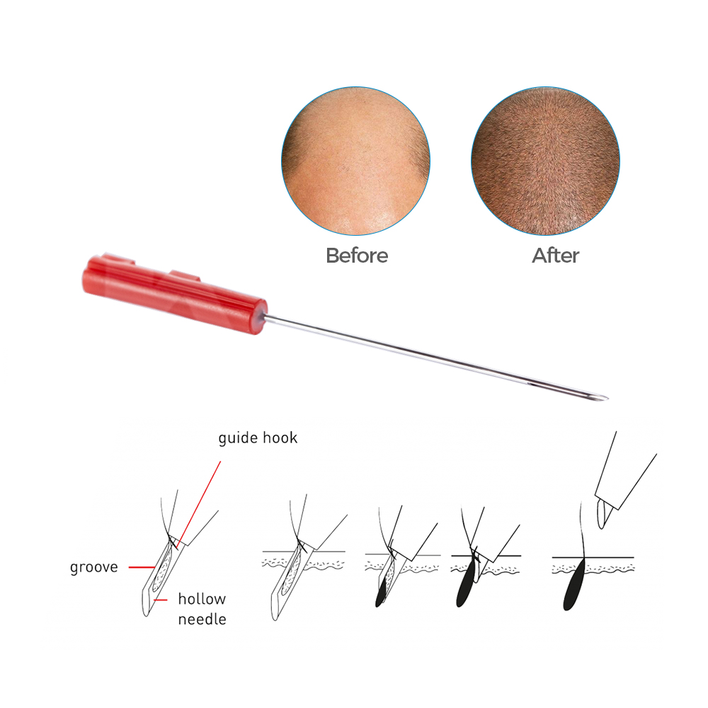 Hair Transplant Needle Manufacturer & Supplier | KDL